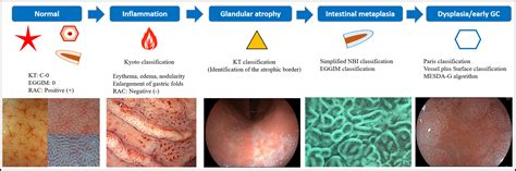 The Endoscopic Model For Gastric Carcinogenesis And Helicobacter Pylori Infection A Potential