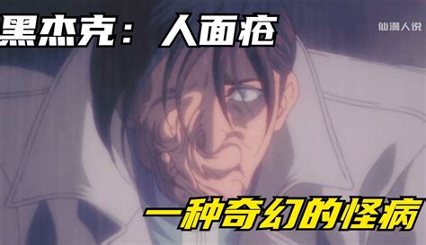 世上最罕见的病症人面疮 爱奇艺