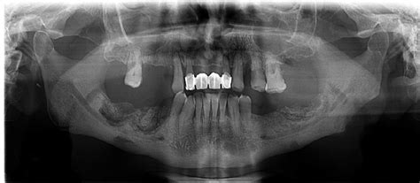Bilateral Mandibular Sequestrum Premolar Avulsion Download Scientific Diagram