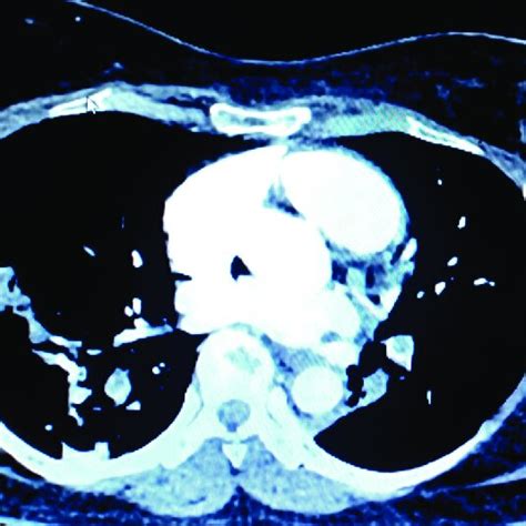 Filling Defects In Bi Lateral Segmental Pulmonary Arteries Ctpa Image