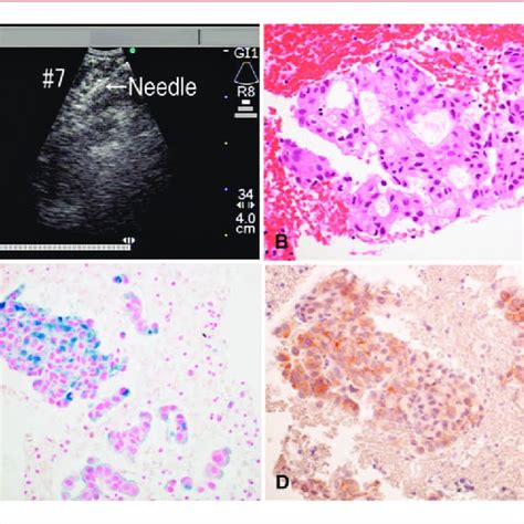 Diagnosis Of Metastatic Nodes By Ebus Tbna A Lymph Node Sampling By Download Scientific