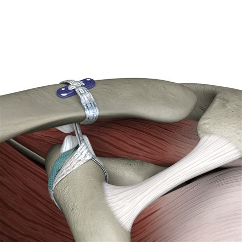 Infinity Lock Button Pitch Patch By Anstem Medical In South Africa