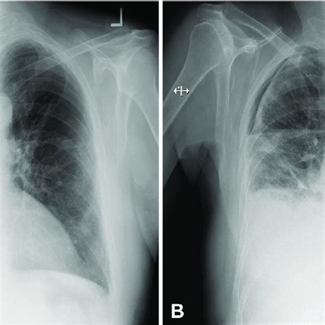 Chest Radiography A Old Radiographs Showing Scattered Patchy Nodular