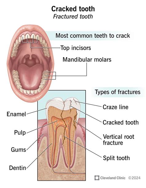 Cracked Tooth Solving The Silent Epidemic Of Cracked Teeth Spear