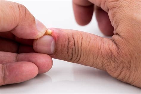Paronychia Nail Problem Causes And Treatment Naturally Aleecare
