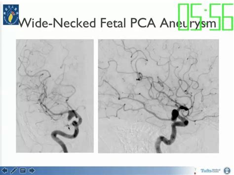 Adel Malek：neuroform Atlas支架在颅内动脉瘤治疗中的应用丨ocin2017精彩回顾 脑医汇