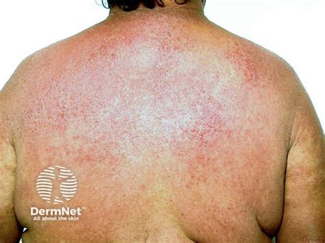 Drug Induced Photosensitivity Dip Images— Dermnet