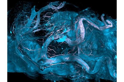Novel Spatial Omics Technology Enables Investigation Of Diseases At