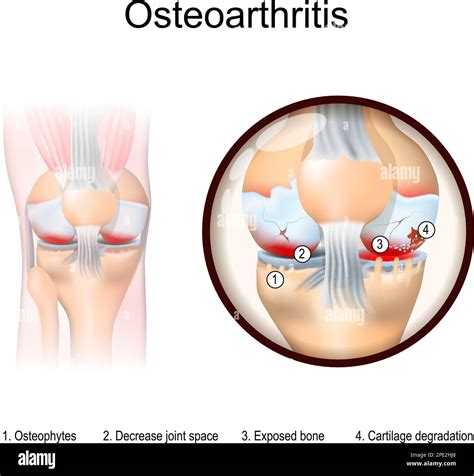 Osteoarthritis Human Leg With Inflammation Of Knee Close Up Of Knee