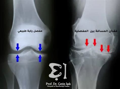 التهاب مفصل الركبة، أبرز طرق العلاج د شتين اشيك