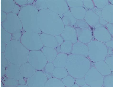 Figure 1 From Primary Mesenteric Liposarcoma Successfully Diagnosed By