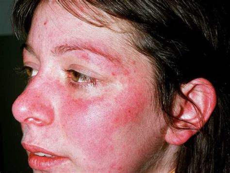Figure Systemic Lupus Erythematosus Dermnet New Zealand Statpearls