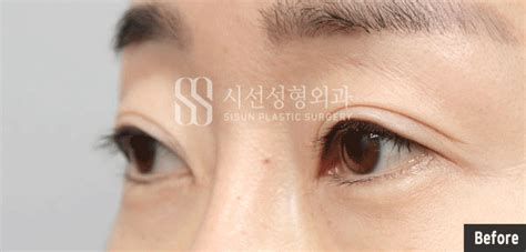 상안검수술비용 노화로 인한 눈꺼풀처짐 해결법은 Doctors Note 눈재수술 시선성형외과