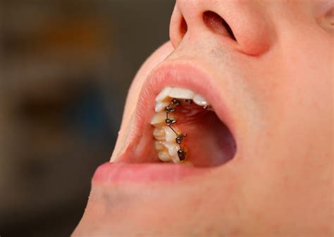 Win Lingual Braces Cost Of Treatment Kingston Orthodontics