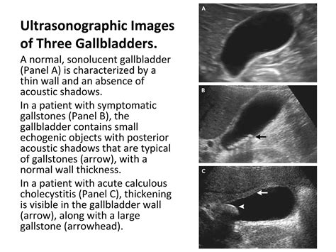 Acute Calculous Cholecystitis Ppt