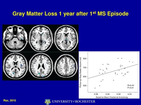 Multiple Sclerosis Doug Symptom Presentation And Course Ppt Download