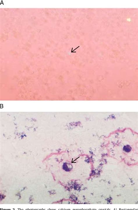 Calcium Oxalate Crystals In Synovial Fluid