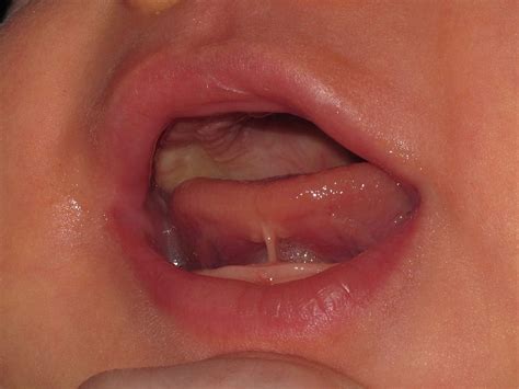 Frenectomy And Tongue Tie Laser Treatment Sydney Cosmic Smile
