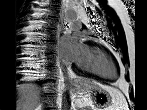 Cardiac Mri Psir Delayed 2ch Images