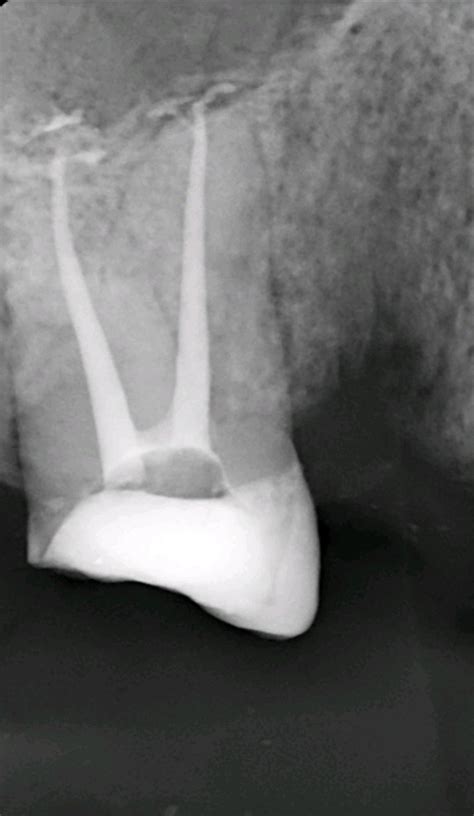 Tooth 14 Dg Asymptomatic Irreversible Pulpitis Th Endodontic