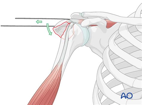 Orif Screw Or Suture Fixation For Extraarticular 2 Part Greater