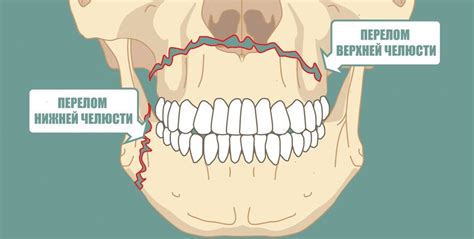 Перелом челюсти Arimed