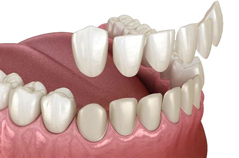 Porcelain Veneers Kalaa Dental Care