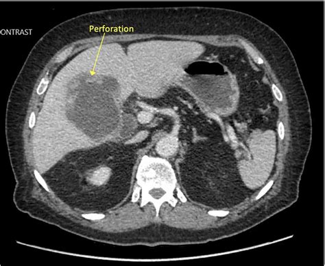 Perforated Gallbladder R Radiology