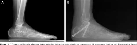 Figure 2 From Subtalar Distraction Arthrodesis Using Frozen Allobone