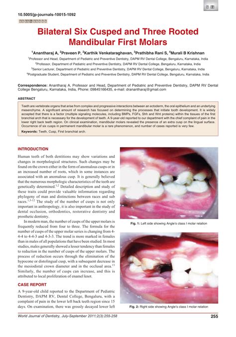 Pdf Bilateral Six Cusped And Three Rooted Mandibular First Molars