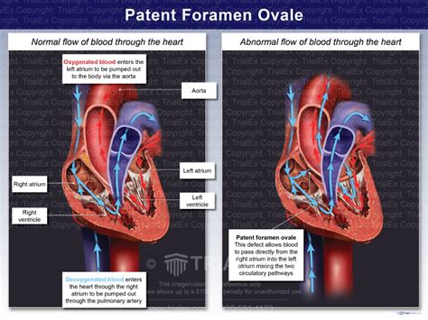 Patent Foramen Ovale Trialexhibits Inc
