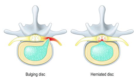 Bulging Disc Vs Herniated Disc Whats The Difference