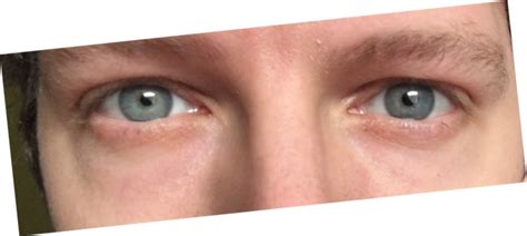 Visian ICL Experience With Visian ICL And Visian ICL Surgery EVO EVO