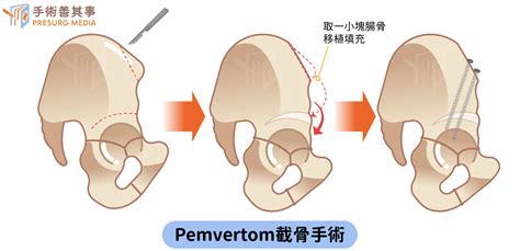 髖關節截骨矯正手術免換人工髖關節！原理、適應症、術後復健