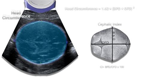 Ob Ultrasound Second Trimester The Basics Sonographic Tendencies