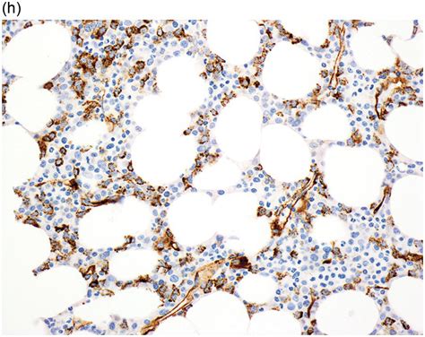 Chapter 8 Myelodysplastic Syndromes Oncohema Key