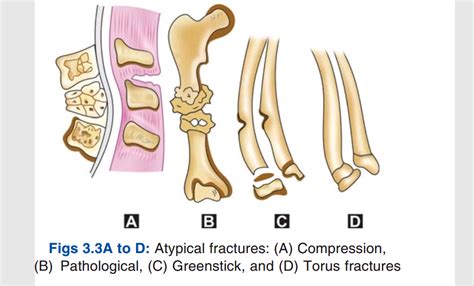 Bone Fractures And Dislocations