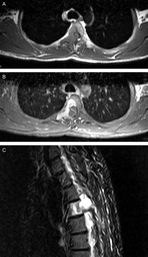 MRI With And Without Contrast Of Thoracic Spine Axial A B And