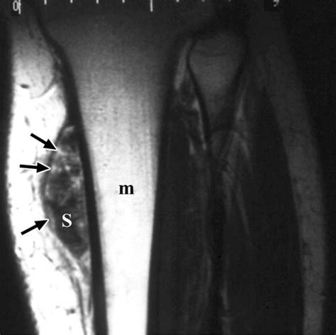 Parosteal Osteosarcoma Mri