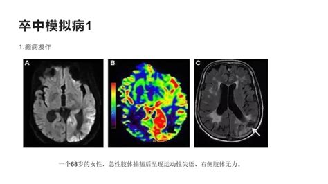 急性缺血性脑卒中的静脉溶栓治疗 脑医汇