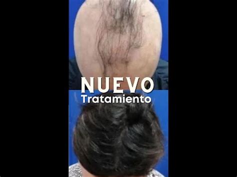 Recuperaci N Capilar C Mo Hacer Para Recuperar Pelo De Forma Efectiva