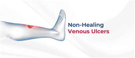 Non Healing Venous Ulcers United Hospital