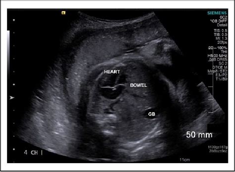 Figure 5 From Sonographic Evaluation Of A Fetal Right Sided