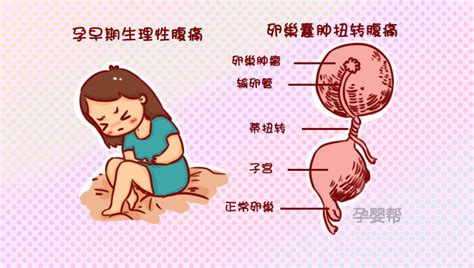 6种孕期腹痛正常或异常要分清