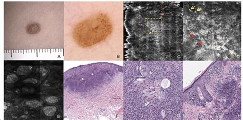 Atypical Skin Lesion Correlations Between Clinical Dermoscopy