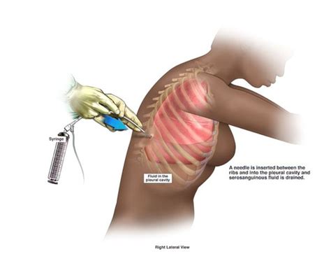 Thoracentesis Anatomy