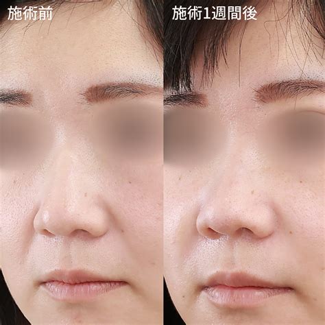 気になる法令線が脂肪注入で薄くなりました。｜症例写真・ビフォーアフター｜美容整形･美容外科のtaクリニックグループ