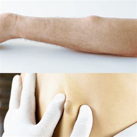 Lipoma And Sebaceous Cyst Surgery Safe Removal By Experts