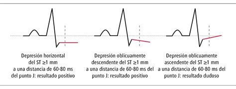 Segmento St Valoracion Y Analisis Del Segmento St