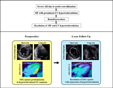 Reversible Left Ventricular Hypertrabeculation And Hypermetabolism